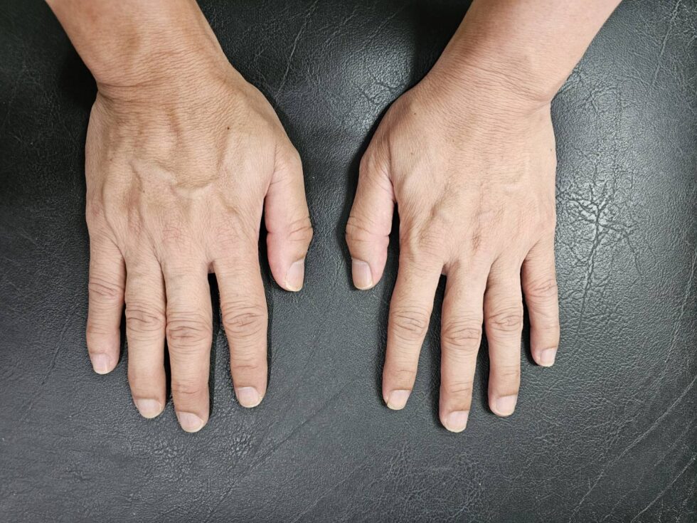 Sclerotherapy for Prominent Hand Veins - legvein clinic thailand